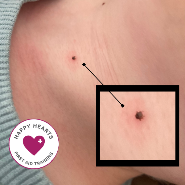 Parents! Everything you need to know about ticks - Happy Hearts First Aid